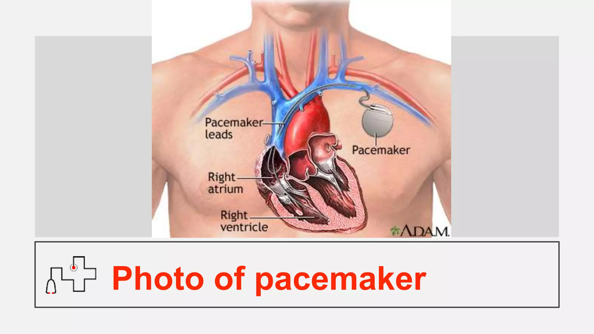 Heart Pacemaker | PPTX | Heart and Cardiovascular Diseases | Diseases ...