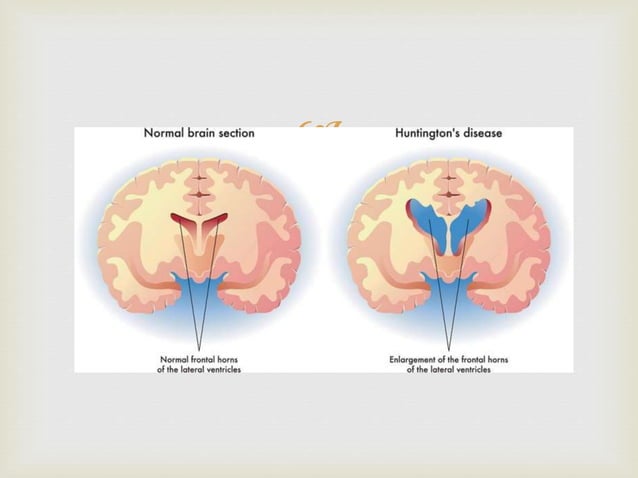 Single Gene Disorder/ Mendalian Disorder - Shumaila Riaz | PPTX