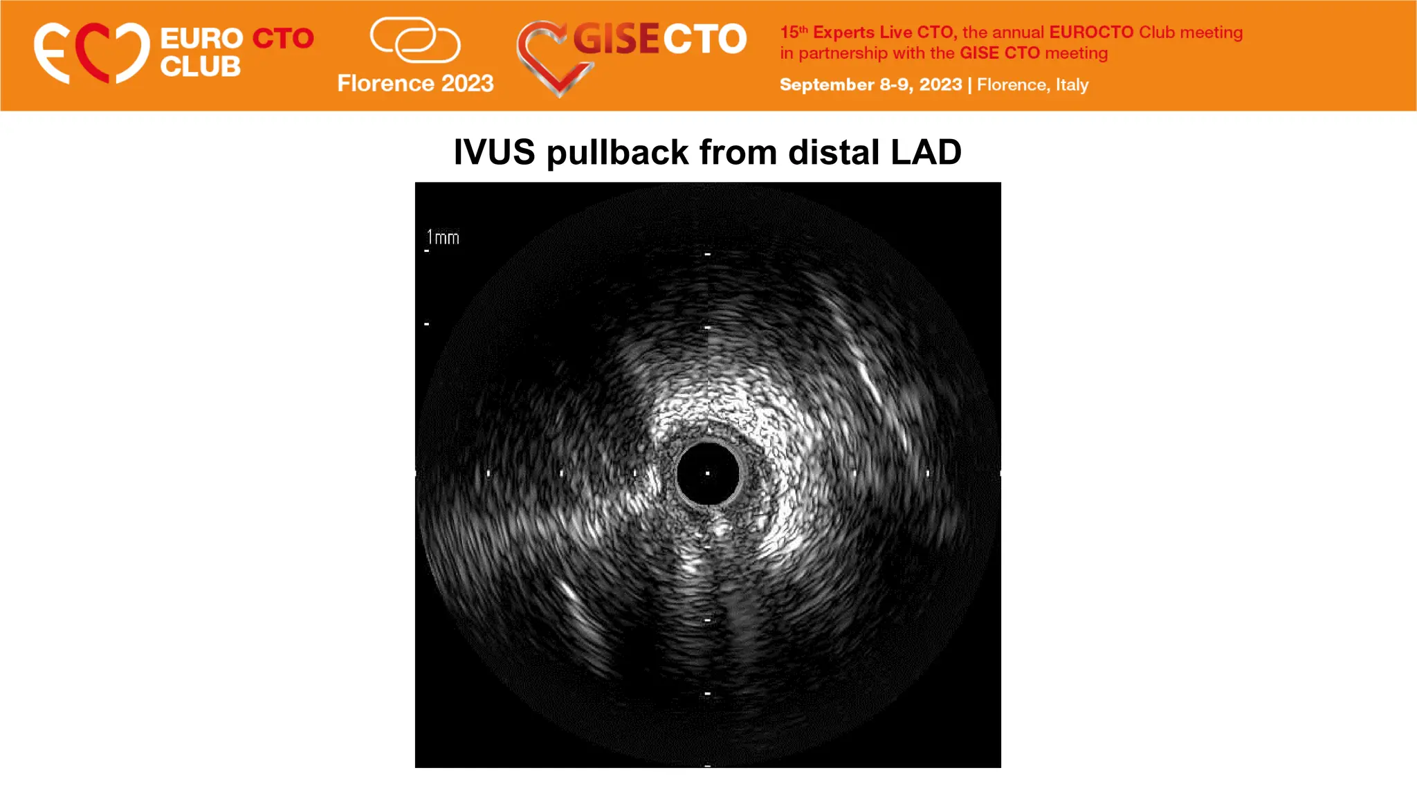 Sunsuke Matsuno: Intracoronary imaging guidance in CTO practice | PDF ...