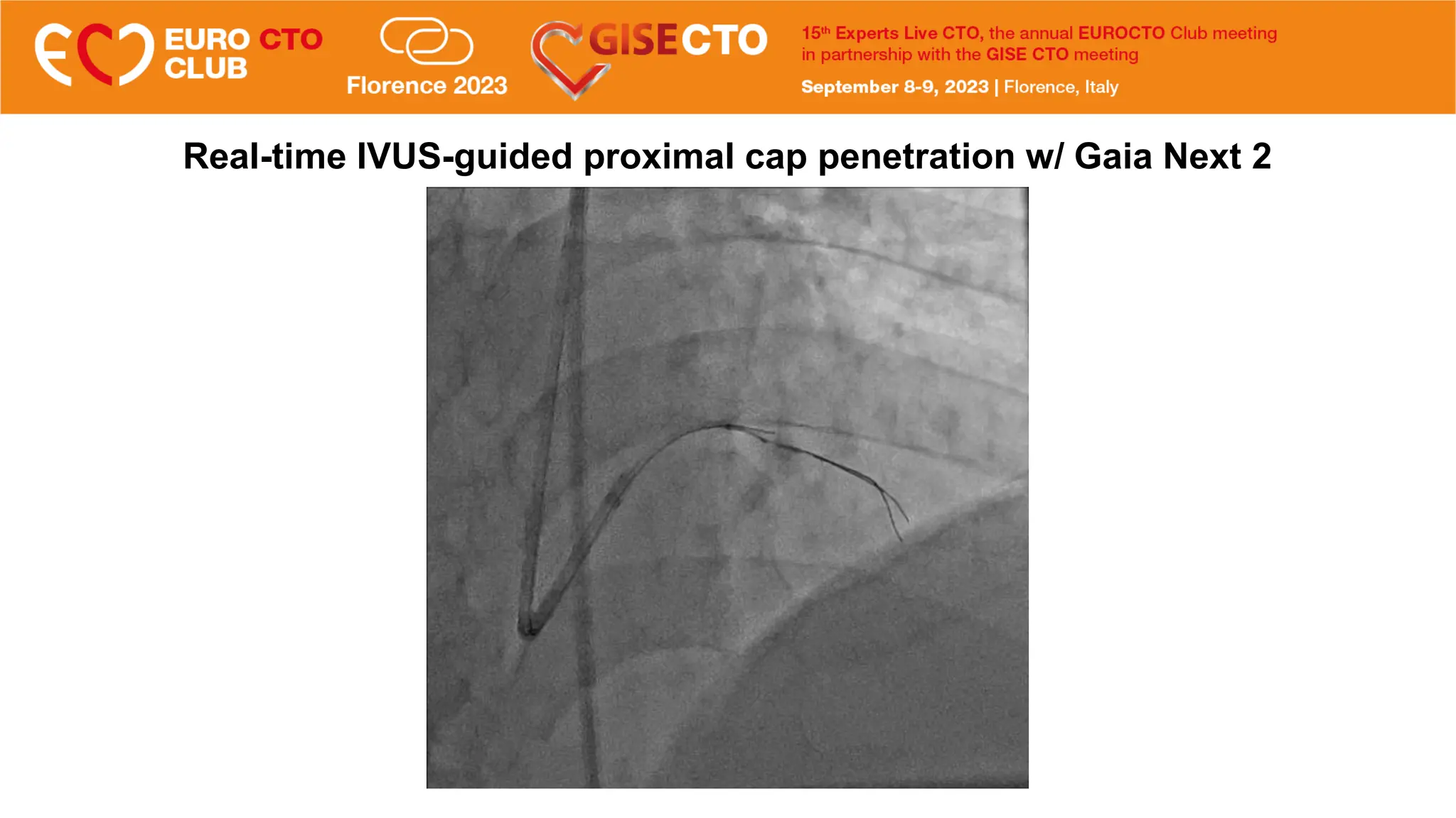 Sunsuke Matsuno: Intracoronary imaging guidance in CTO practice | PDF ...
