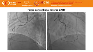 Sunsuke Matsuno: Intracoronary imaging guidance in CTO practice | PDF ...