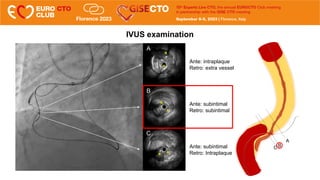 Sunsuke Matsuno: Intracoronary imaging guidance in CTO practice | PDF ...