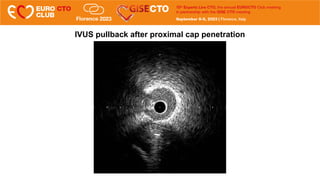 Sunsuke Matsuno: Intracoronary imaging guidance in CTO practice | PDF ...