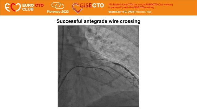 Sunsuke Matsuno: Intracoronary imaging guidance in CTO practice | PDF ...