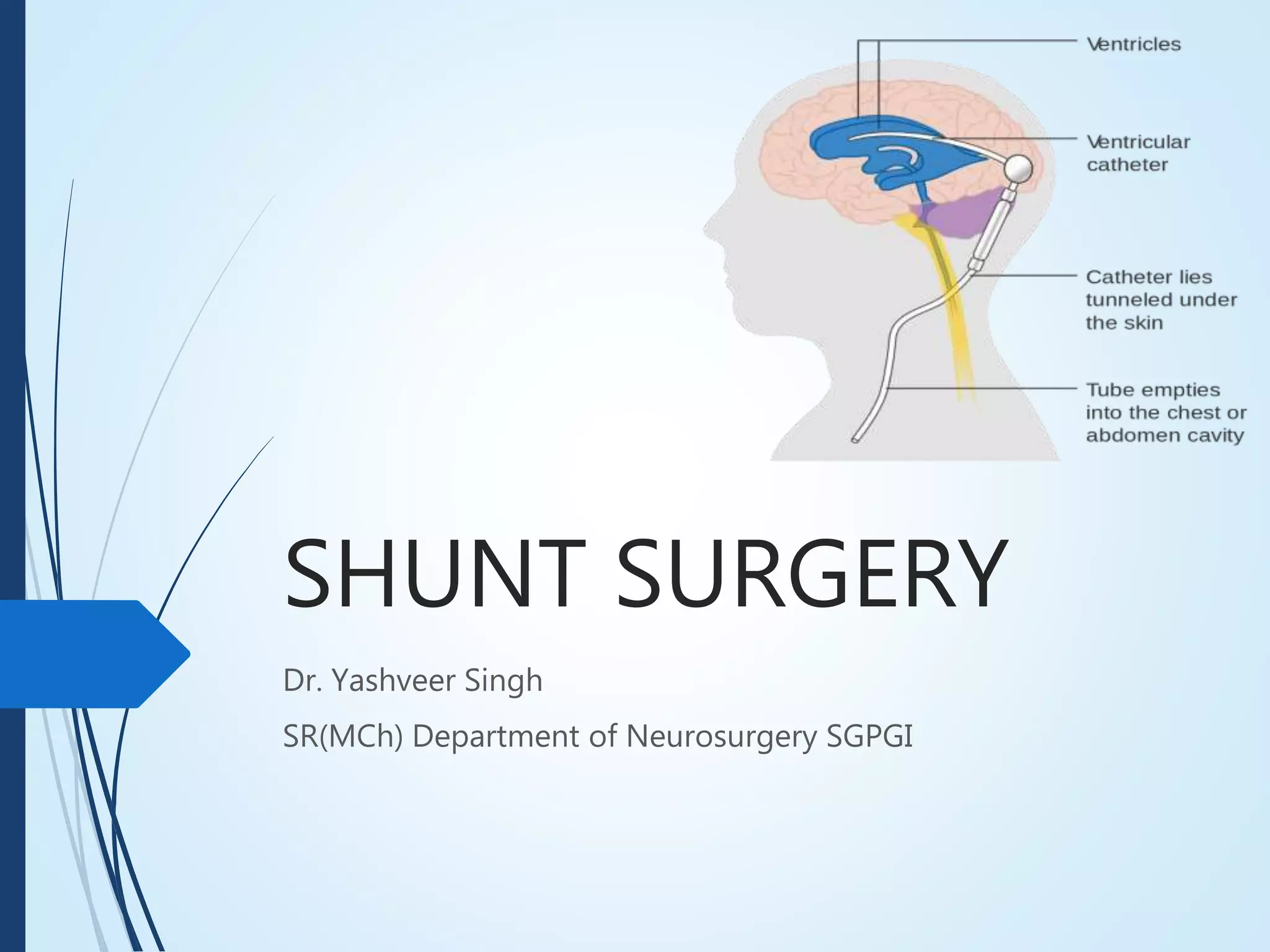 Shunt Surgery | PPTX