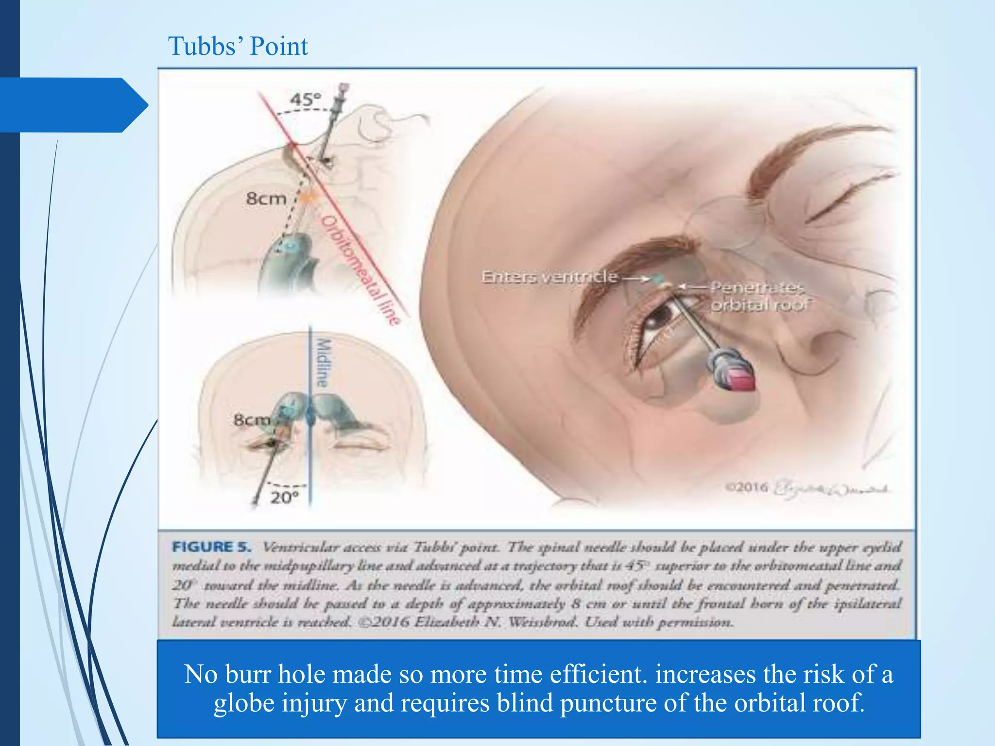 Shunt Surgery | PPTX