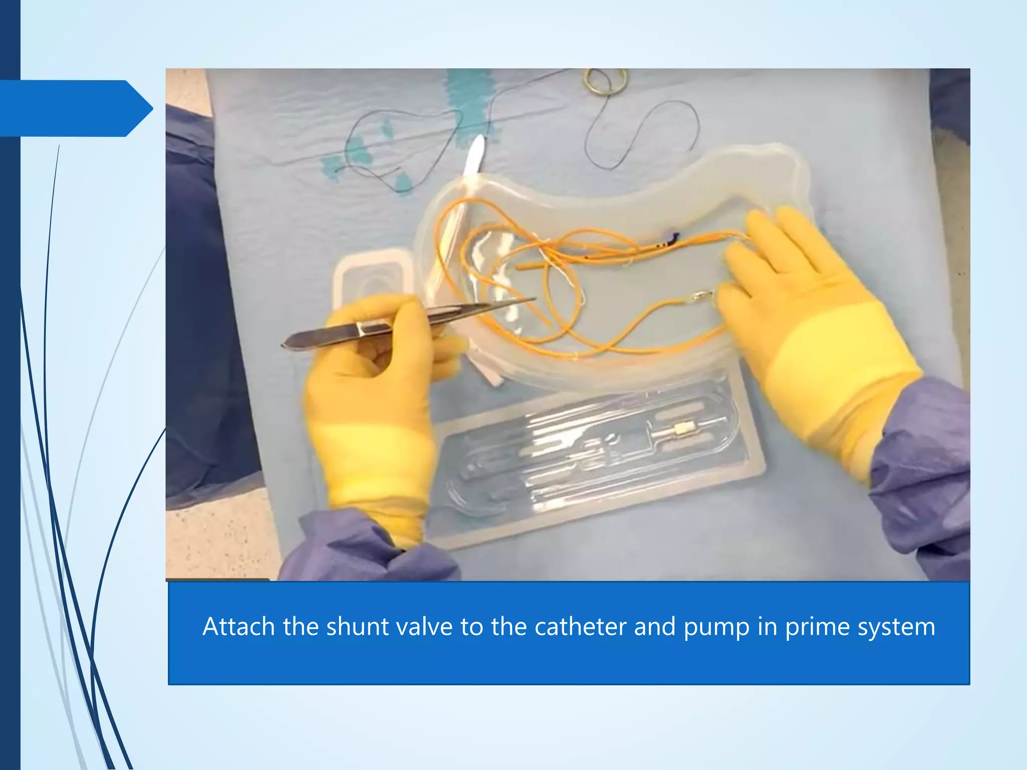 Shunt Surgery | PPTX