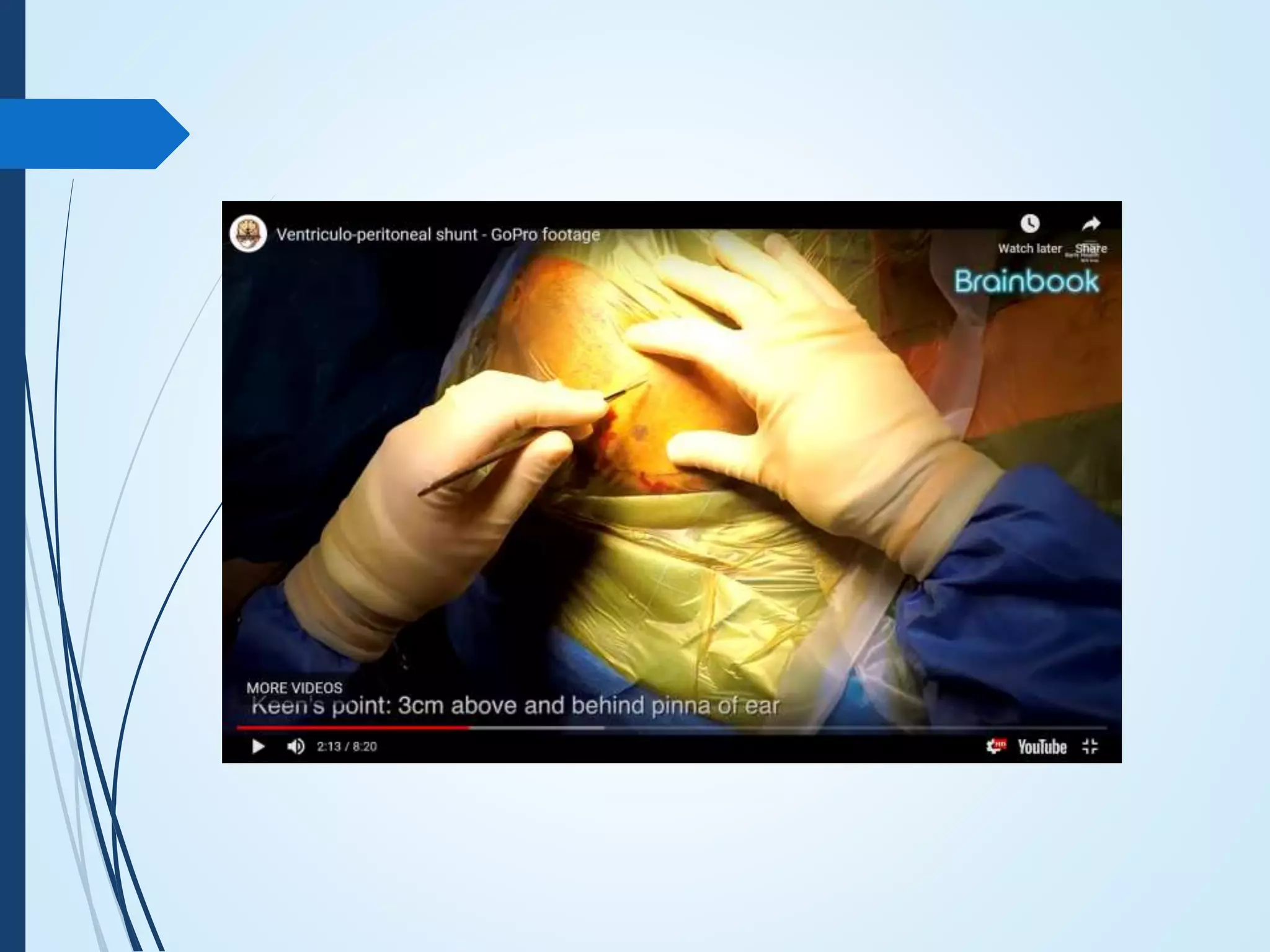 Shunt Surgery | PPTX