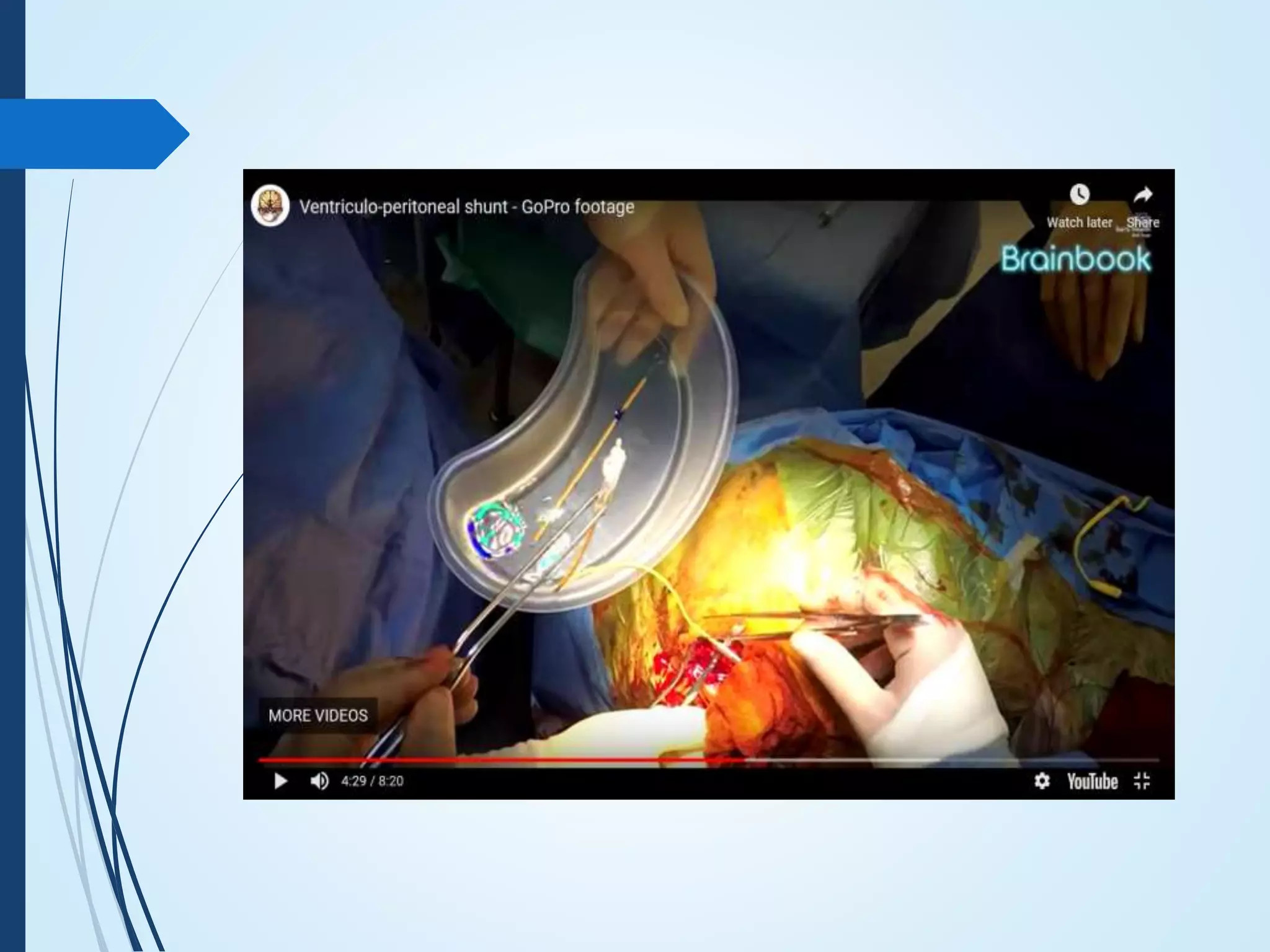 Shunt Surgery | PPTX