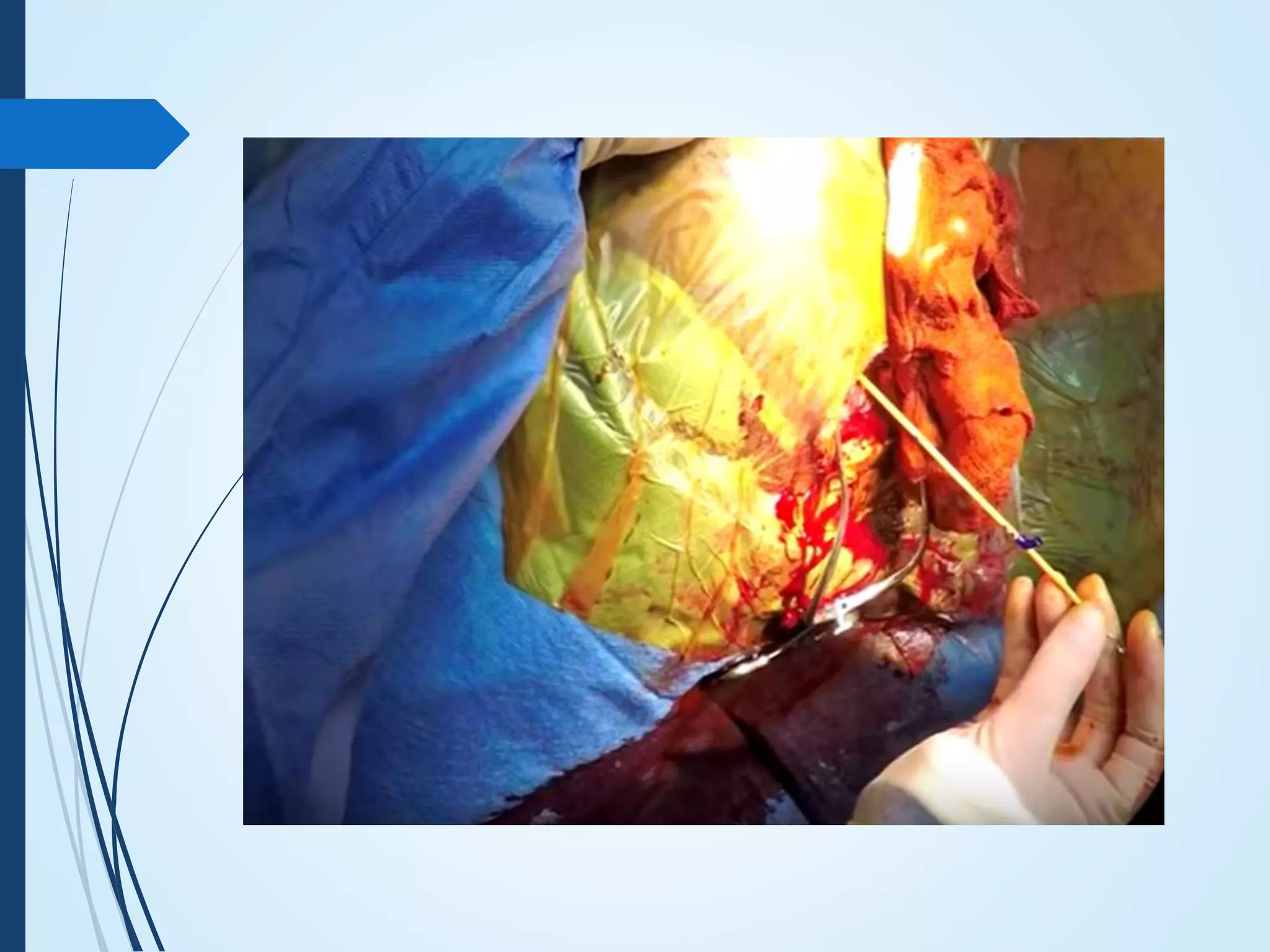 Shunt Surgery | PPTX