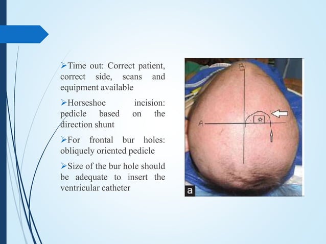 Shunt Surgery | PPTX | Brain and Nervous System Disorders | Diseases ...