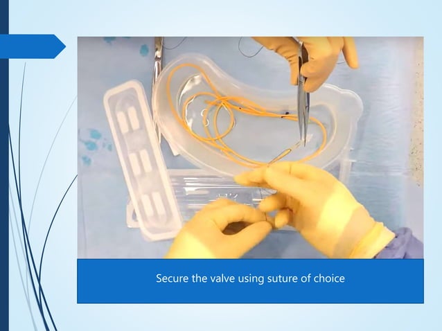 Shunt Surgery | PPTX | Brain and Nervous System Disorders | Diseases ...