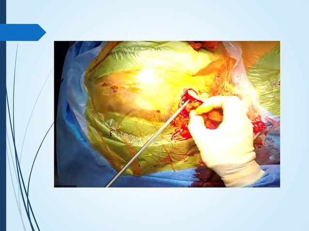 Shunt Surgery | PPTX | Brain and Nervous System Disorders | Diseases ...