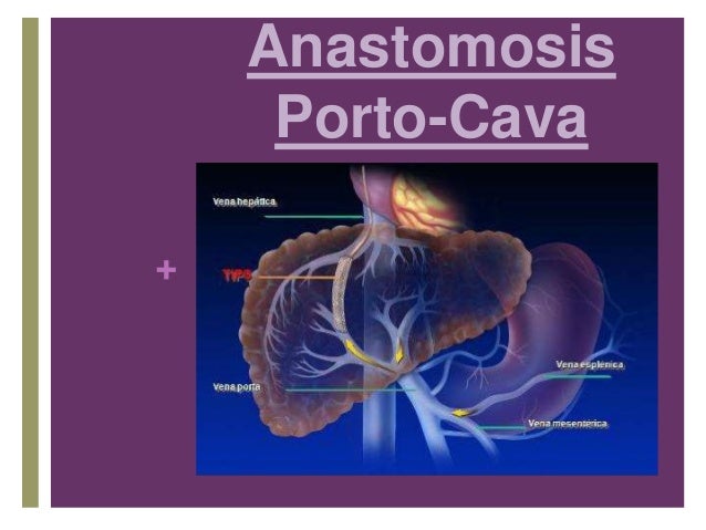 anastomosis porto-cava (shunt)