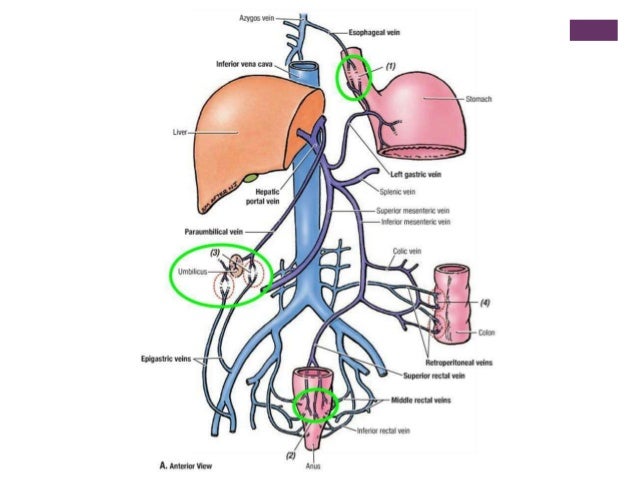 anastomosis porto-cava (shunt)
