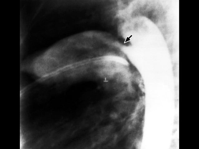 Shunt Detection And Quantification | PPT