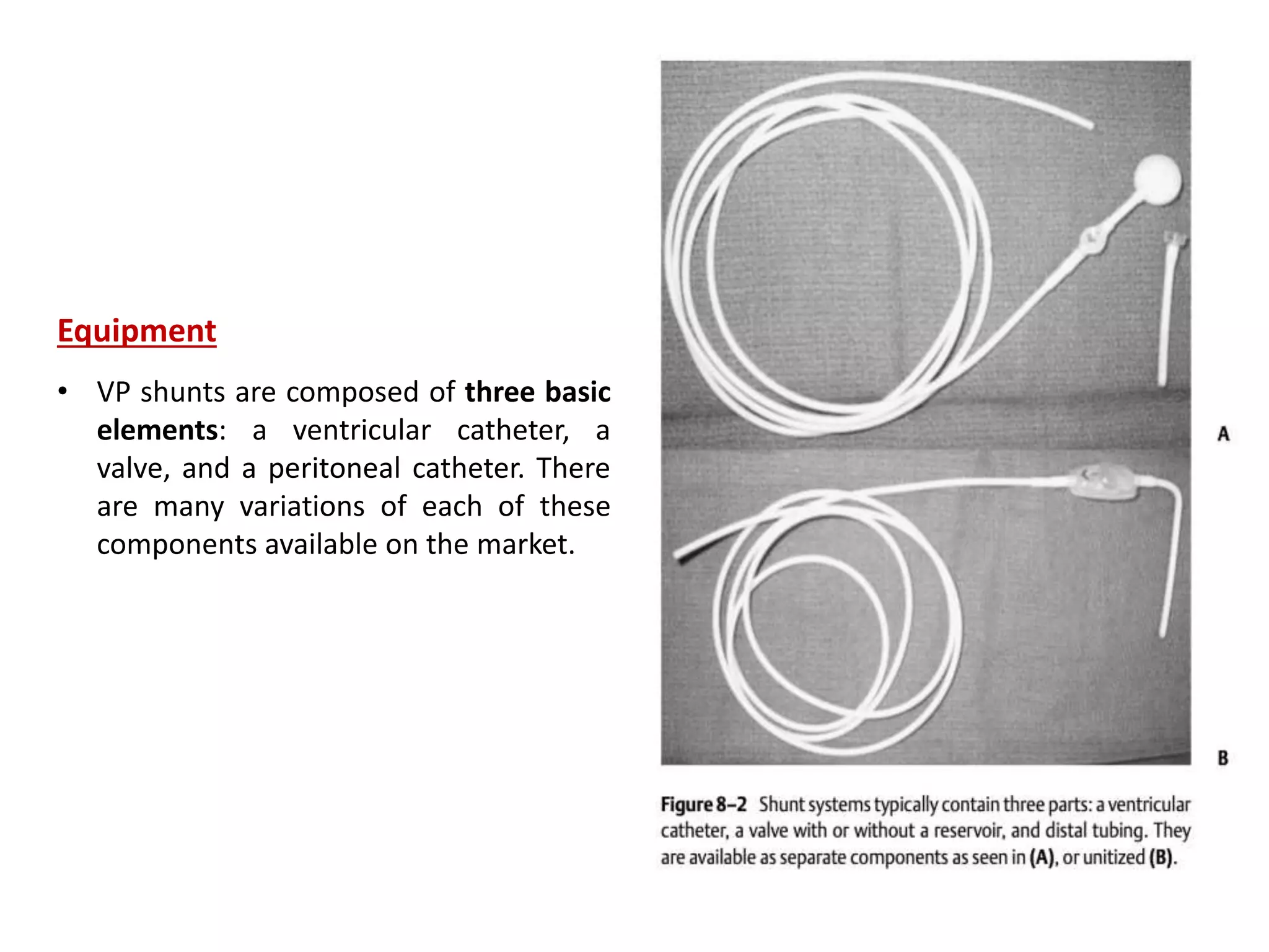 Shunt for hydrocephalus | PPTX