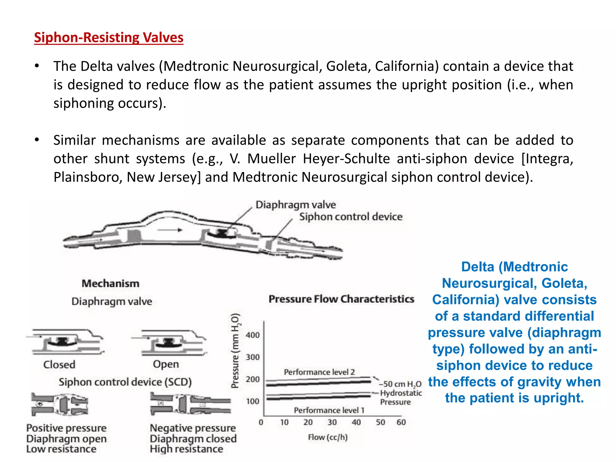 Shunt for hydrocephalus | PPTX