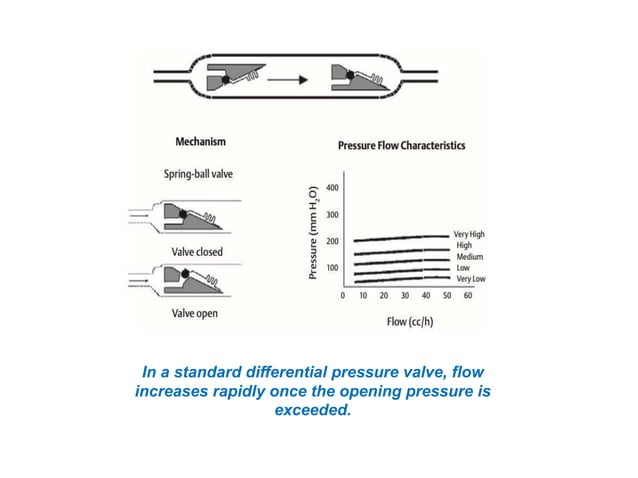 Shunt for hydrocephalus | PPTX | Brain and Nervous System Disorders ...