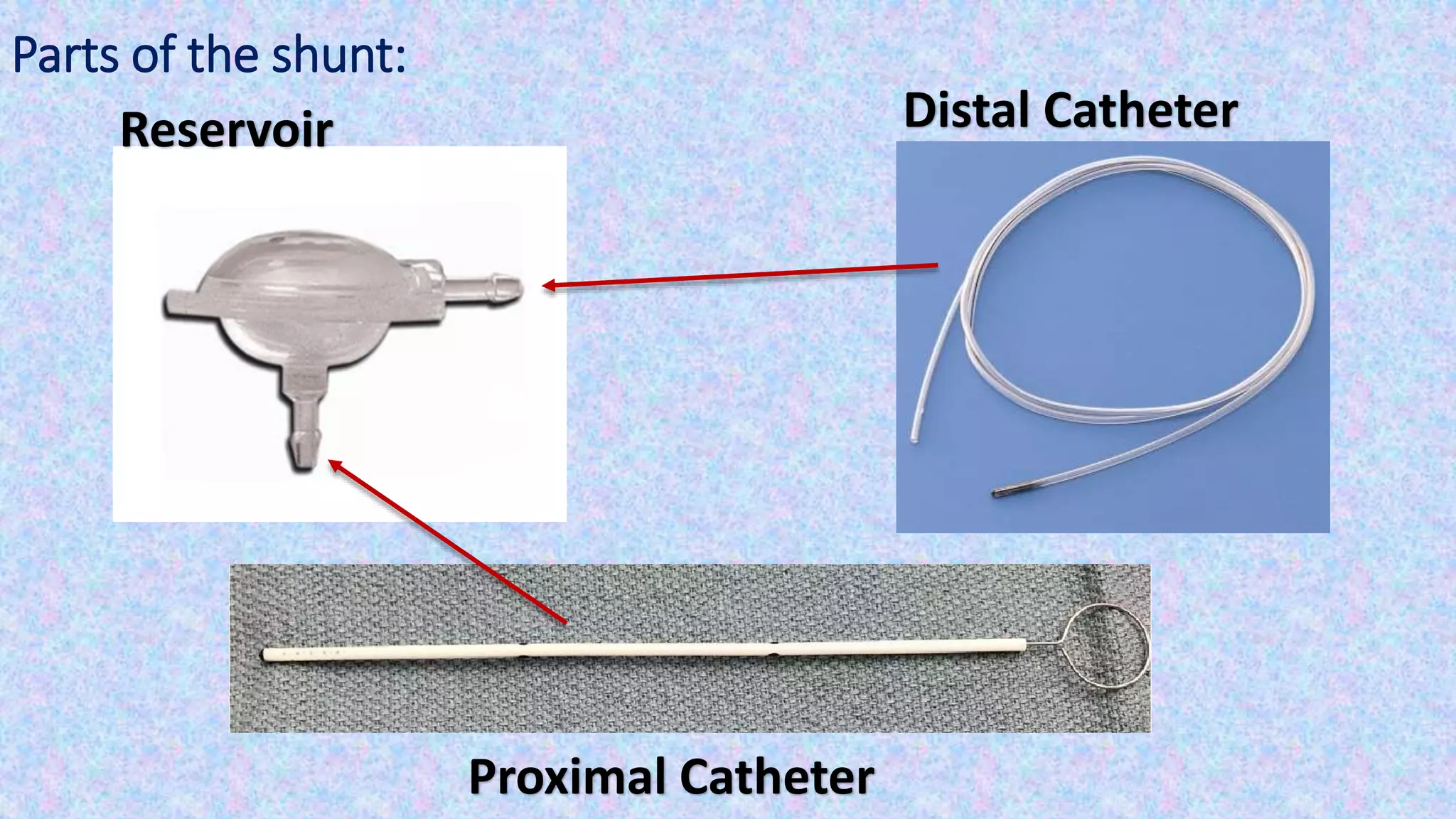 Shunt surgery | PPTX