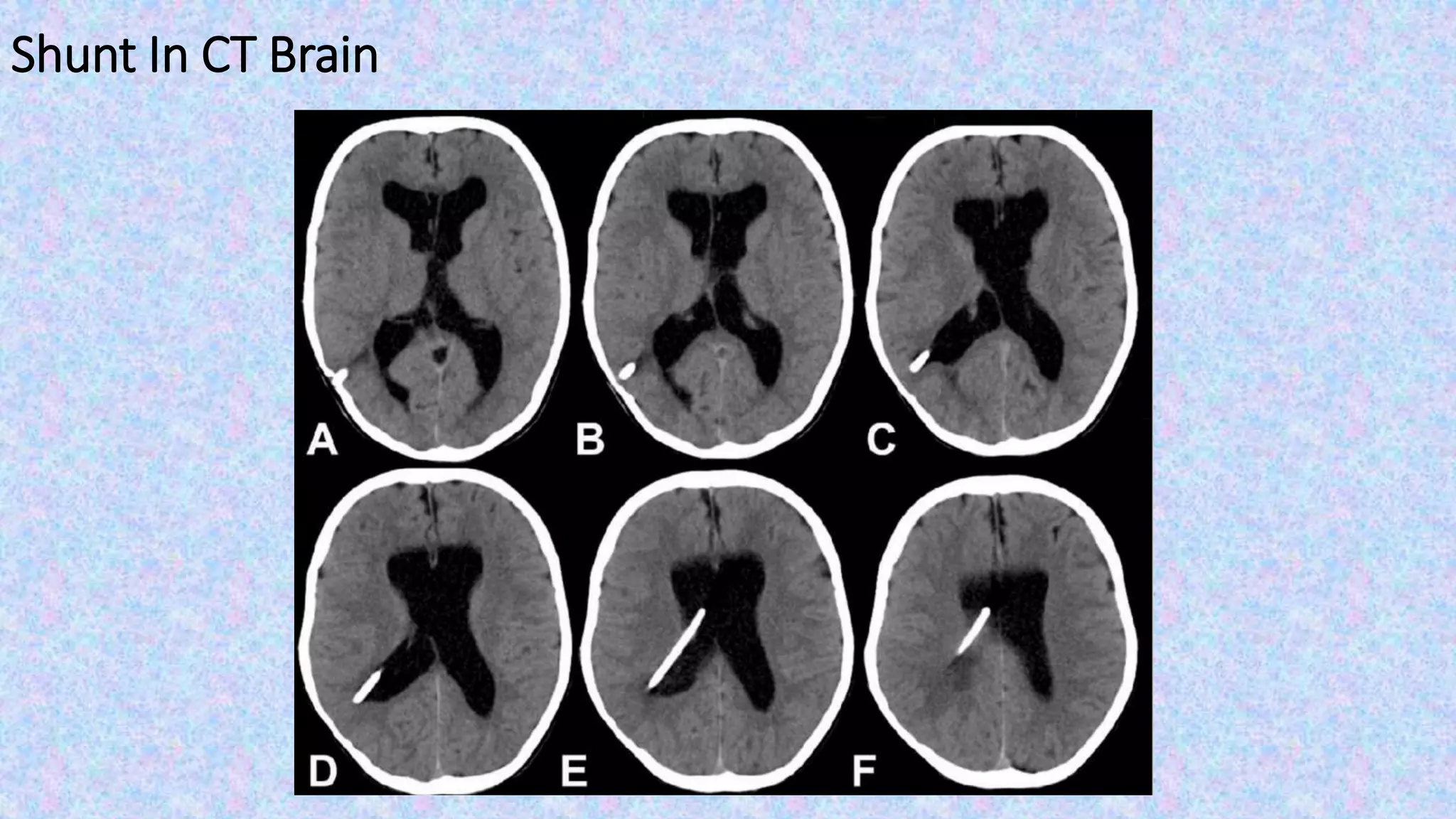 Shunt surgery | PPTX