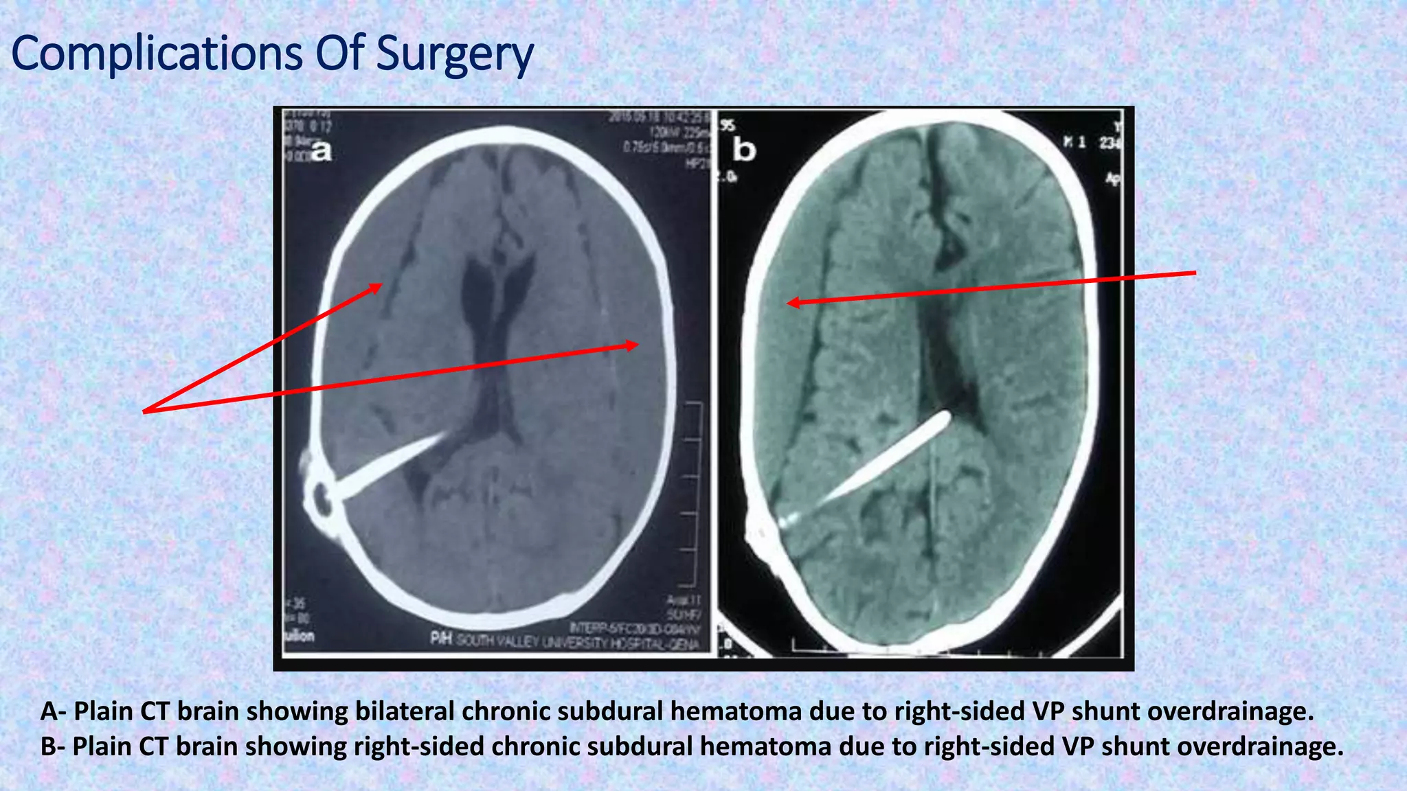 Shunt surgery | PPTX