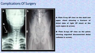 Shunt surgery | PPTX