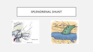 Shunt surgery for portal hypertension.pptx