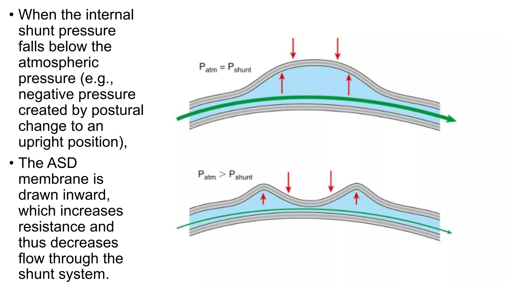 Shunt systems | PPTX