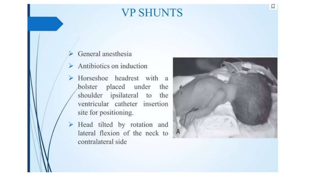 CSF diversion procedure VP shunt surgery.pptx