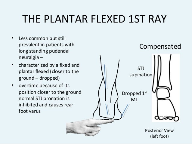 Pudendal Neuralgia and Lower Extremity (Feet) Biomechanics - ICS 201…