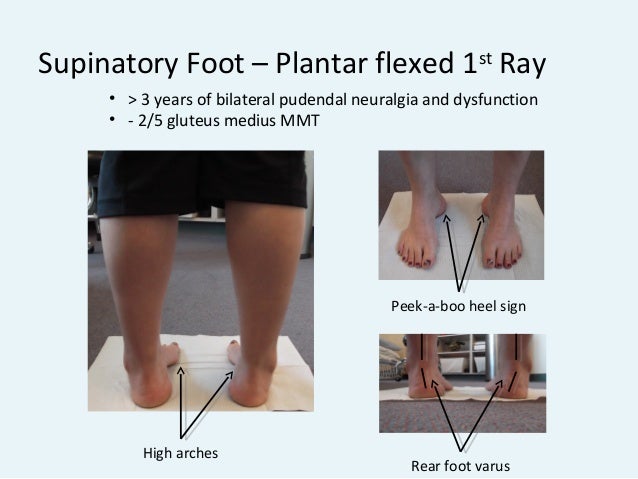 Pudendal Neuralgia and Lower Extremity (Feet) Biomechanics - ICS 201…
