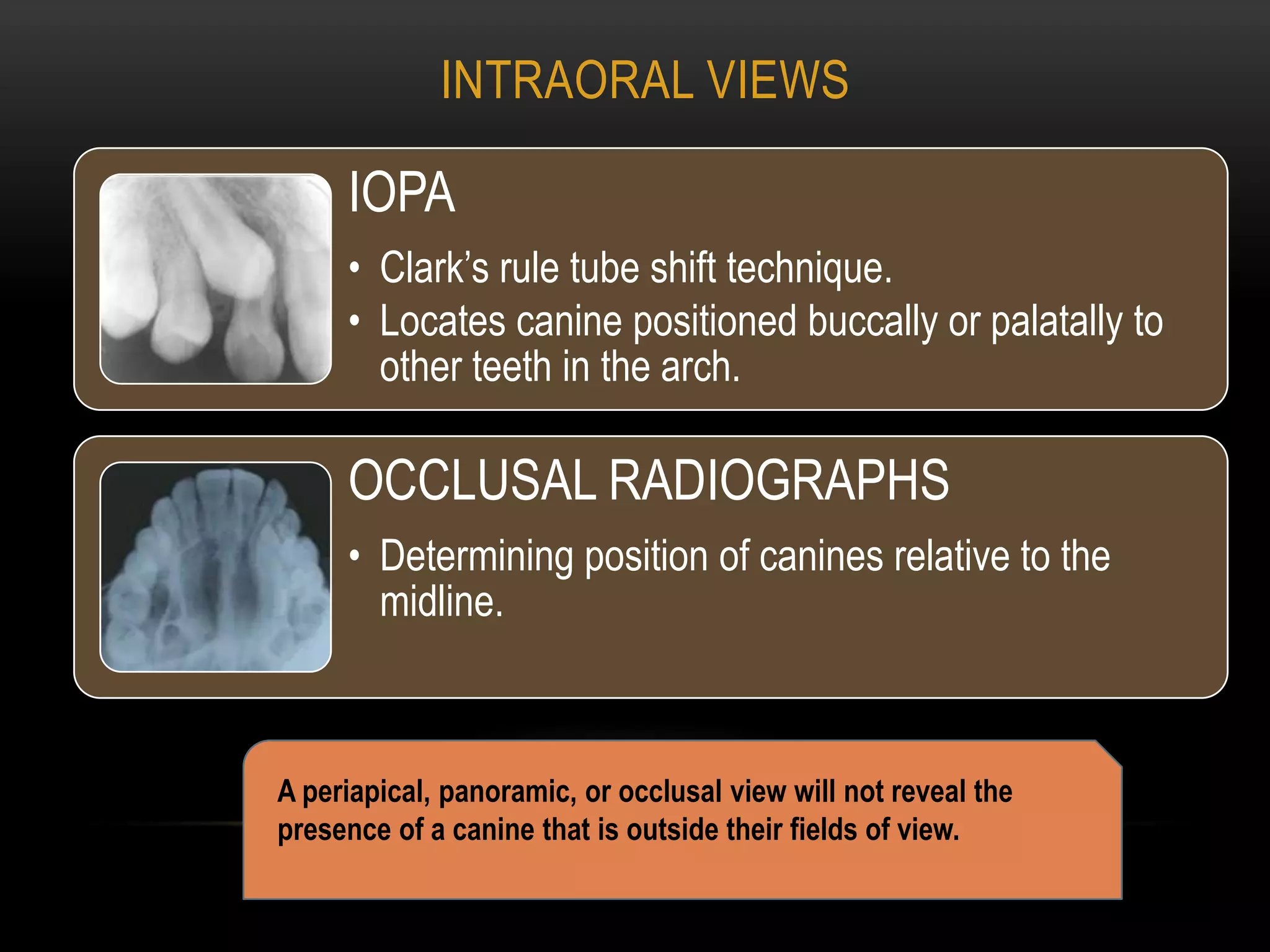 canine impaction | PPTX