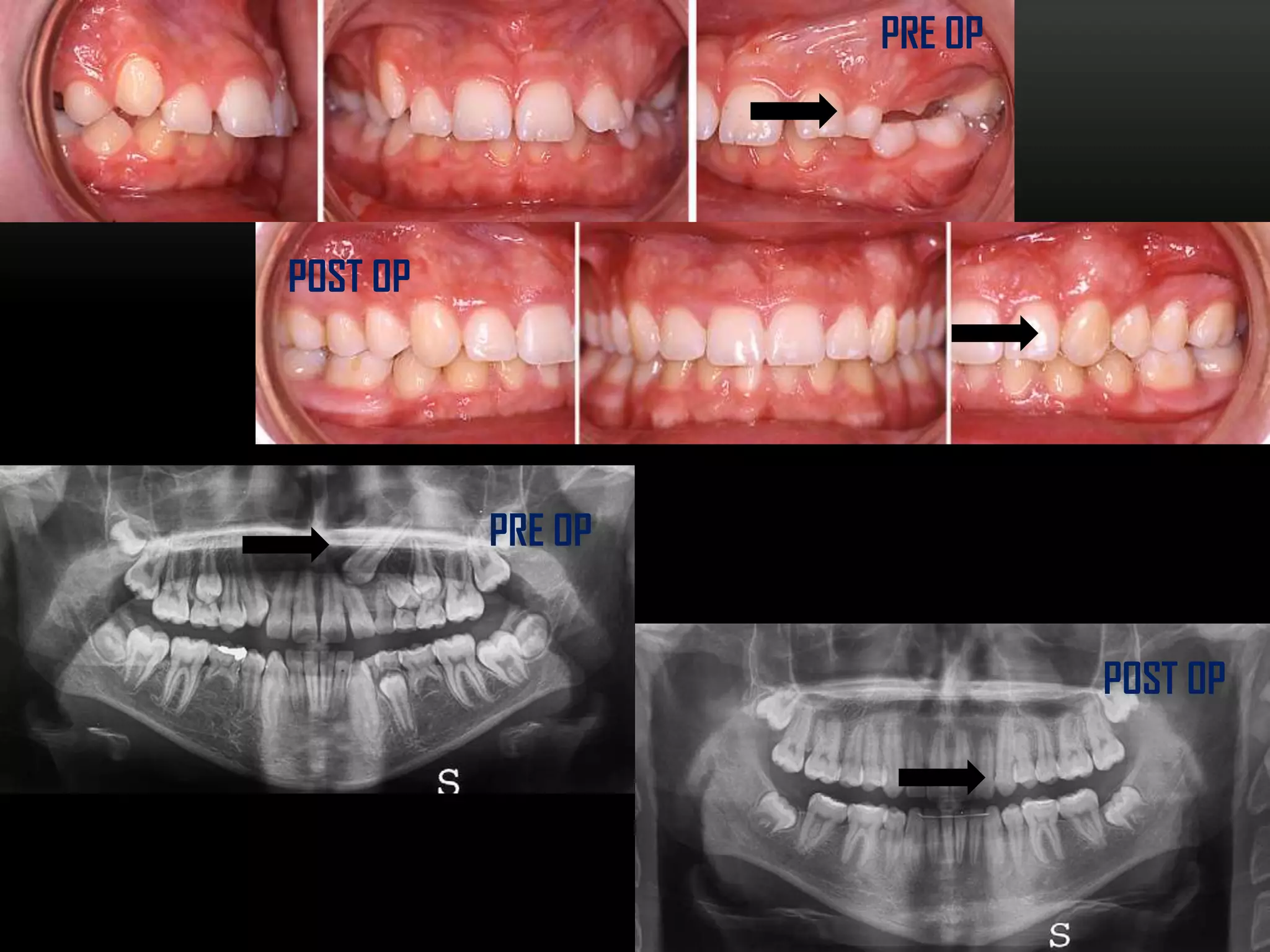 canine impaction | PPTX