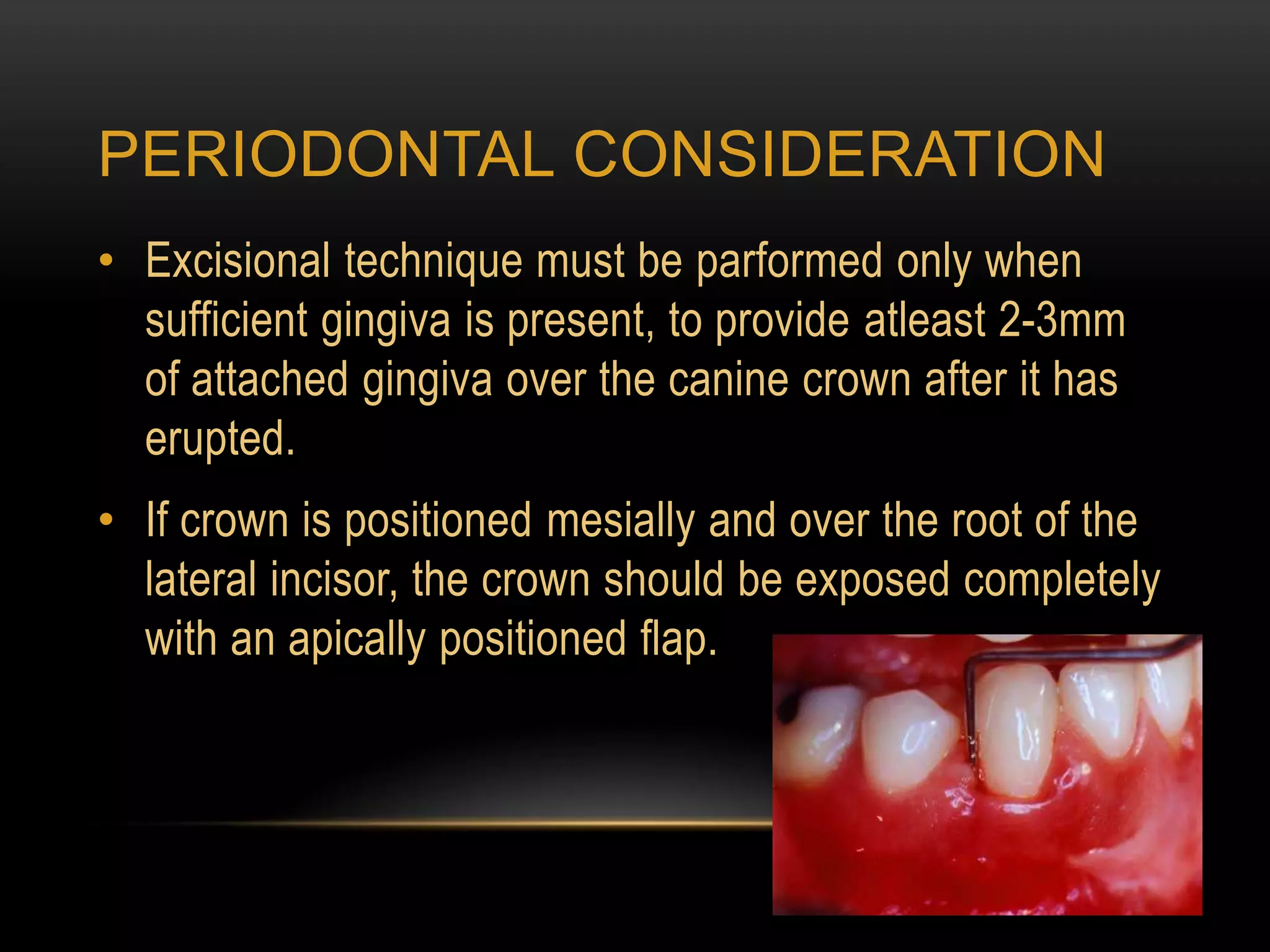 canine impaction | PPTX