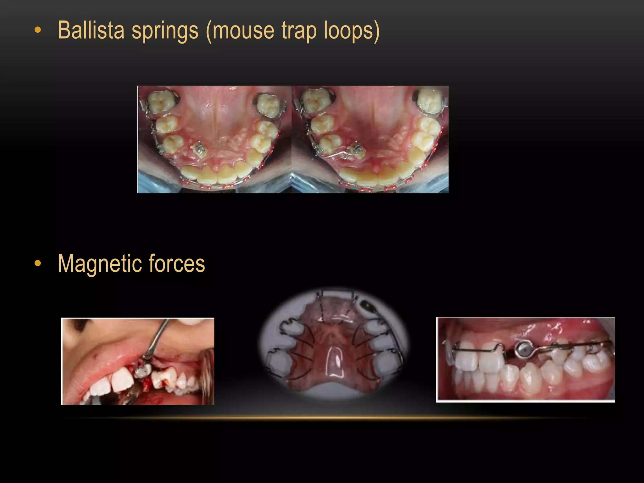 canine impaction | PPTX