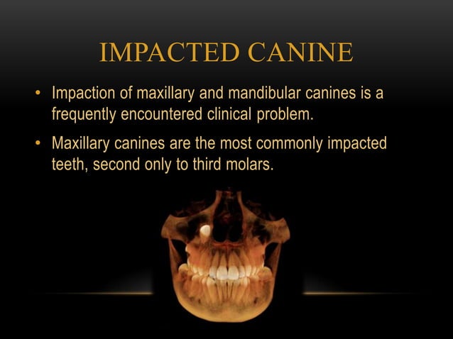 canine impaction | PPTX