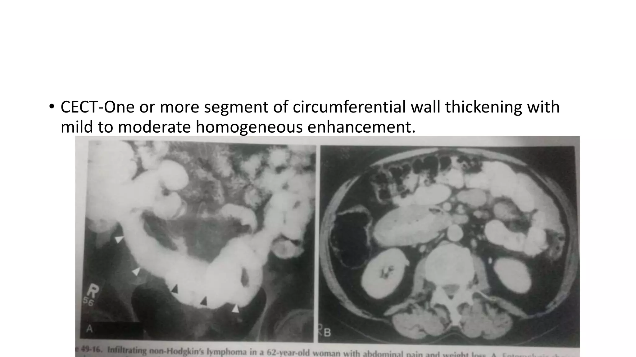 SMALL INTESTINE RADIOLOGY | PPTX