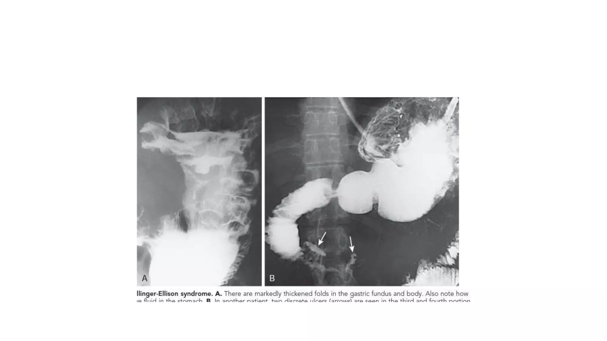 SMALL INTESTINE RADIOLOGY | PPTX
