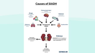 SIADH (Syndrome of inappropriate antidiuretics hormone) | PPTX