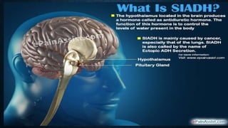 SIADH.pptx used for bachelor of science nursing | PPT