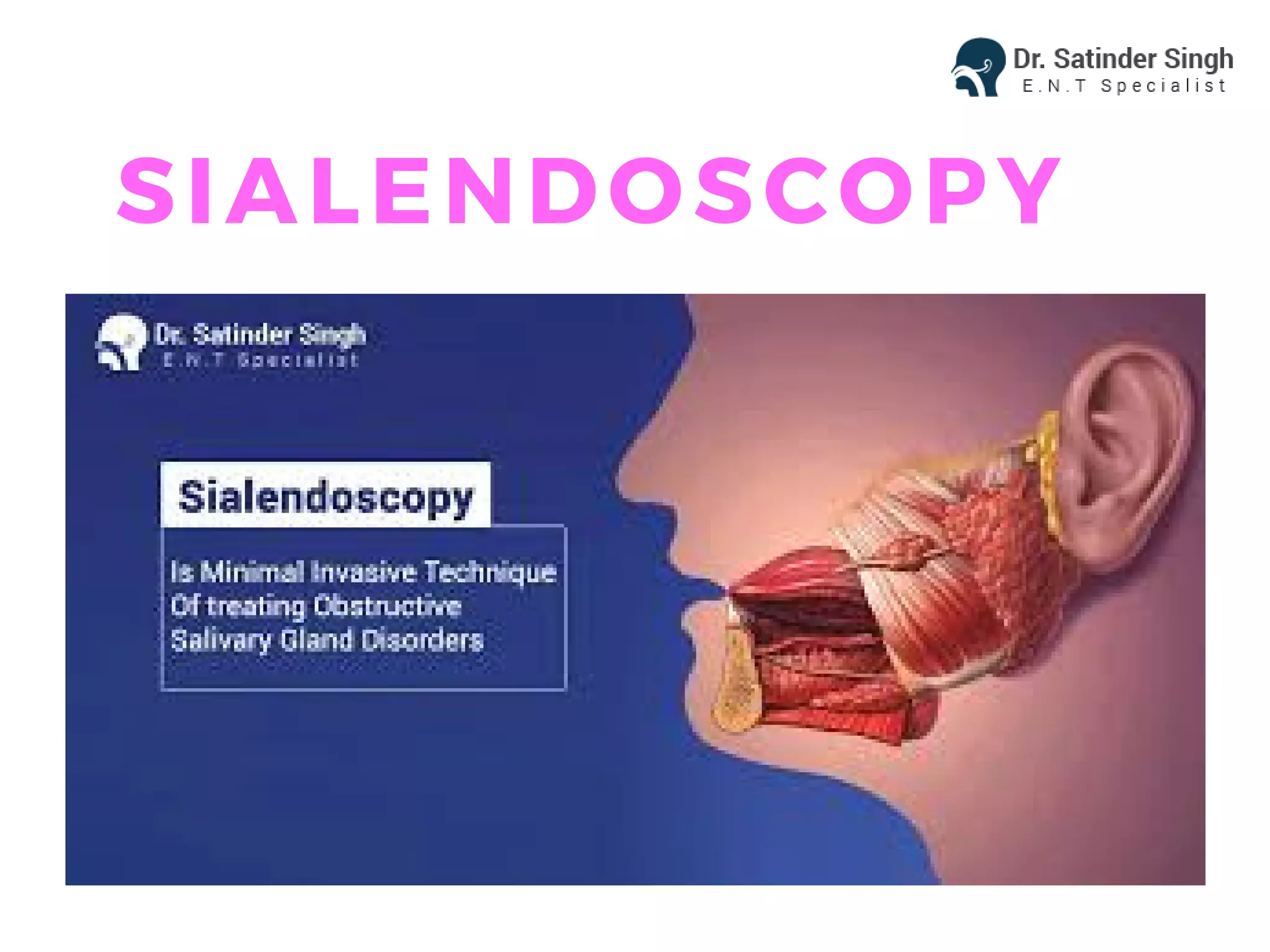 Sialendoscopy | PPT