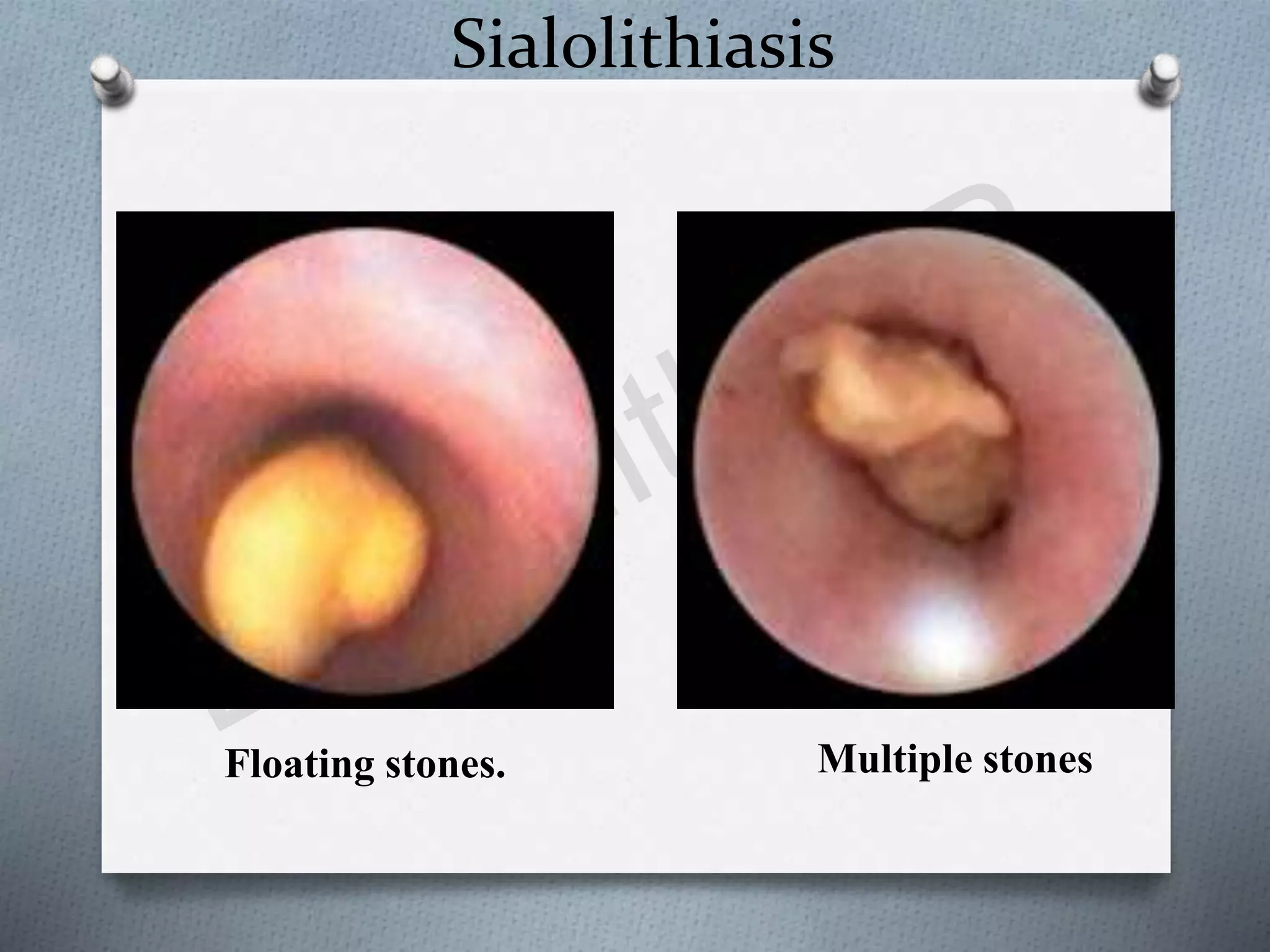 Sialendoscopy dr chithra p | PPT
