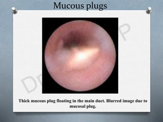 Sialendoscopy dr chithra p | PPT