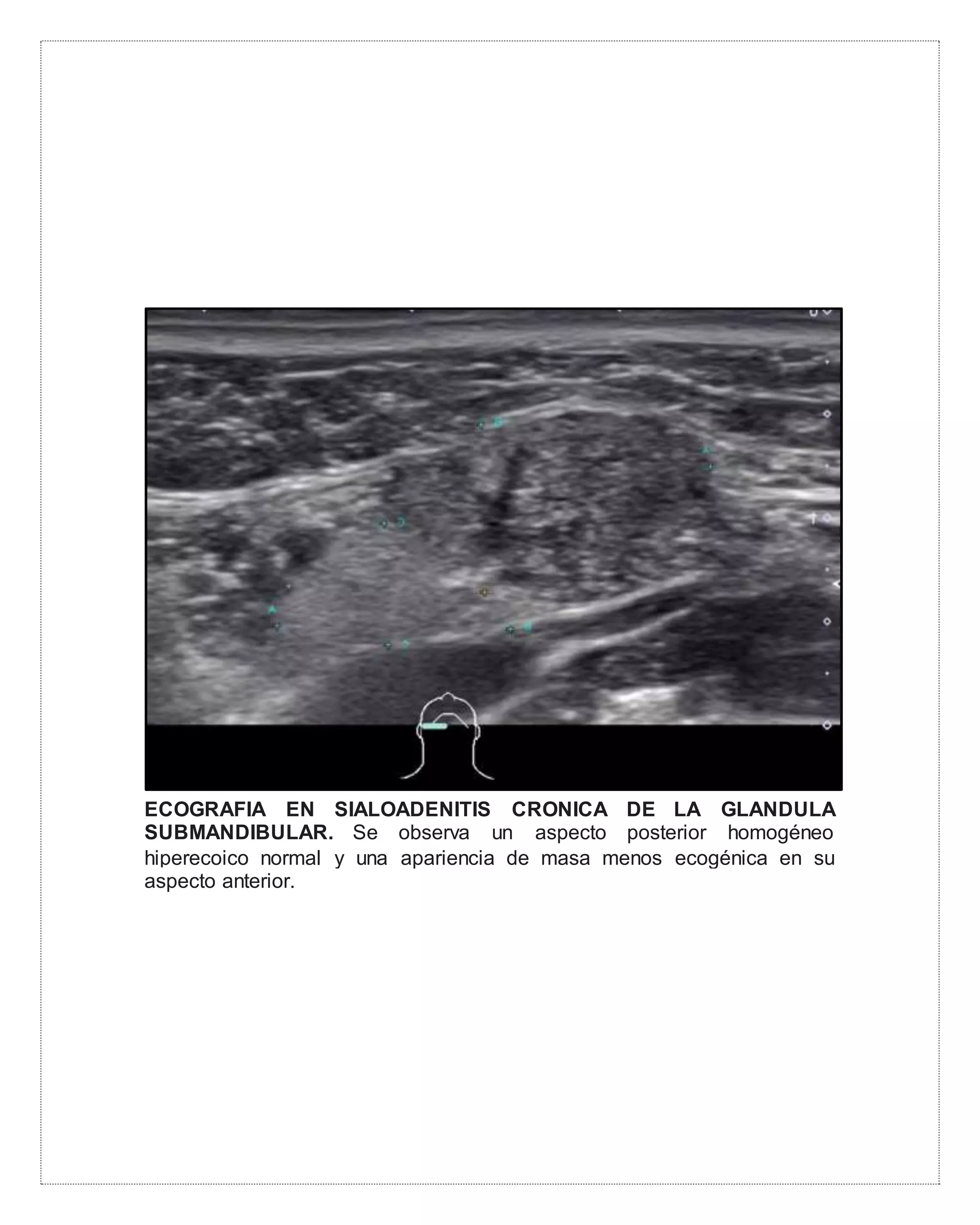Sialoadenitis cronica de la glandula submaxilar | DOCX | Ear, Nose and ...