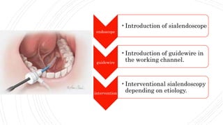 Sialoendoscopy | PPTX
