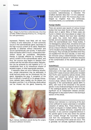 Sialoendoscopy and-salivary-gland-sparing-surgery 2009-oral-and ...