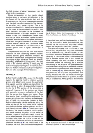 Sialoendoscopy and-salivary-gland-sparing-surgery 2009-oral-and ...