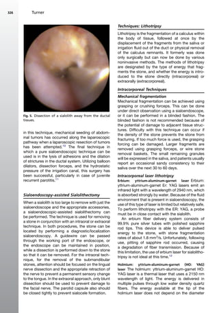 Sialoendoscopy and-salivary-gland-sparing-surgery 2009-oral-and ...