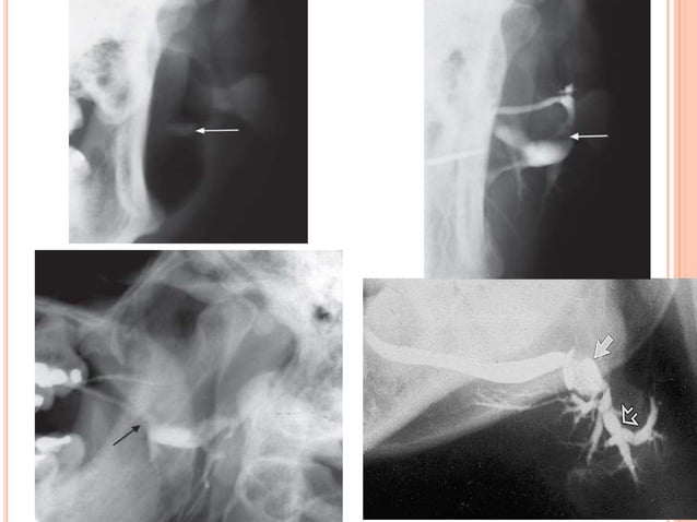 SIALOGRAPHY.pptx | Ear, Nose and Throat Conditions | Diseases and ...